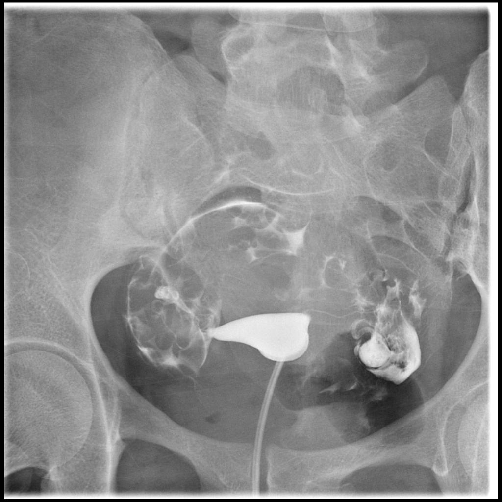 What Is Fluoroscopy Hysterosalpingogram at Becky Craig blog